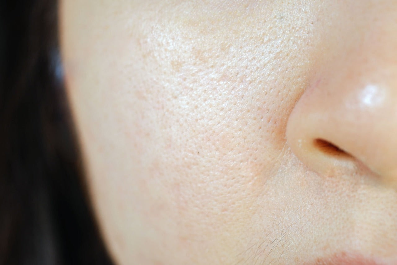 What Is Combination Skin? Signs and Solutions – Ela De Pure